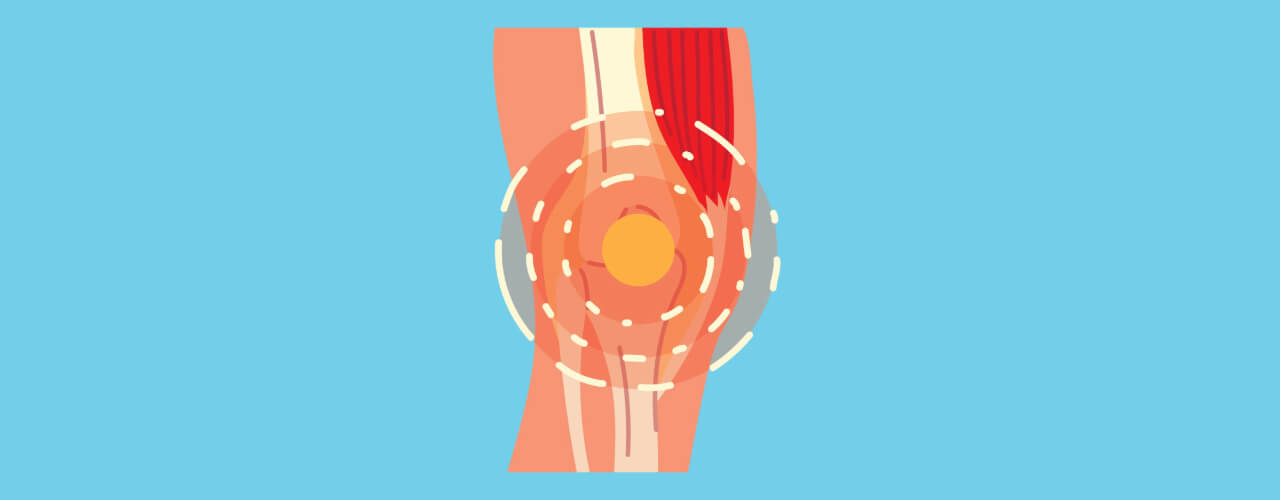 Role of Inflammation in Knee Pain: Causes and Treatments | Blog
